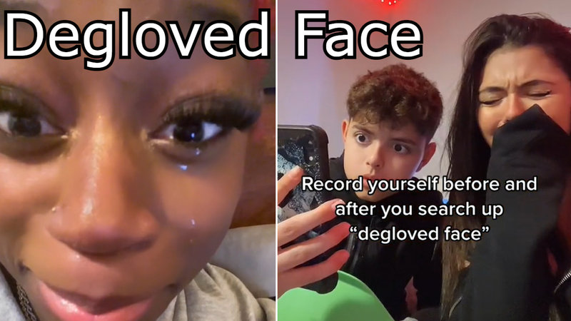 DEGLOVED FACE: CAUSES, TREATMENT, AND PREVENTION - Lifeyet