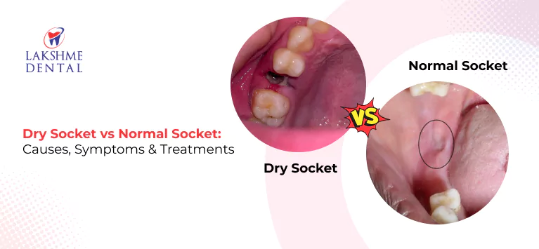 Dry Socket Vs Healthy Socket: Symptoms Explained Dry Socket Vs Healthy Socket: Symptoms Explained